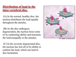 INTERVERTEBRAL DISC ANATOMY AND PIVD OF LUMBAR SPINE AND ITS MANAGEMENT ...