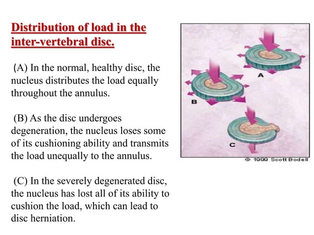 INTERVERTEBRAL DISC ANATOMY AND PIVD OF LUMBAR SPINE AND ITS MANAGEMENT ...