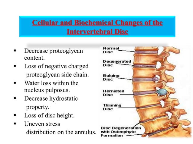 INTERVERTEBRAL DISC ANATOMY AND PIVD OF LUMBAR SPINE AND ITS MANAGEMENT