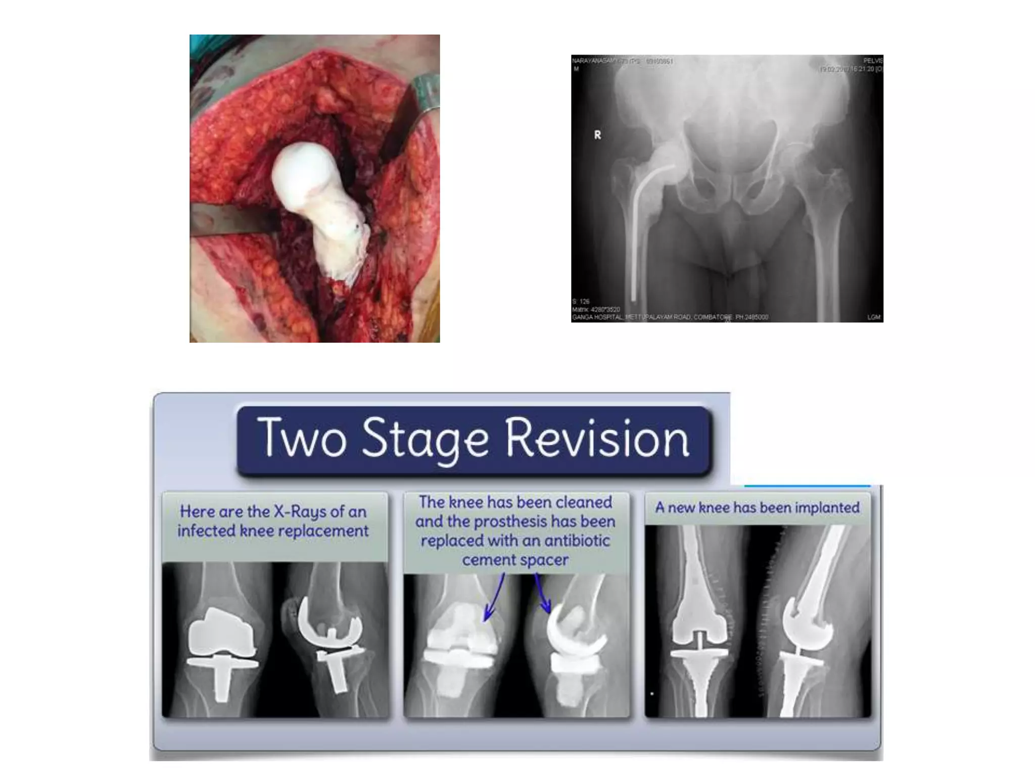 Periprosthetic Joint Infection | PPTX