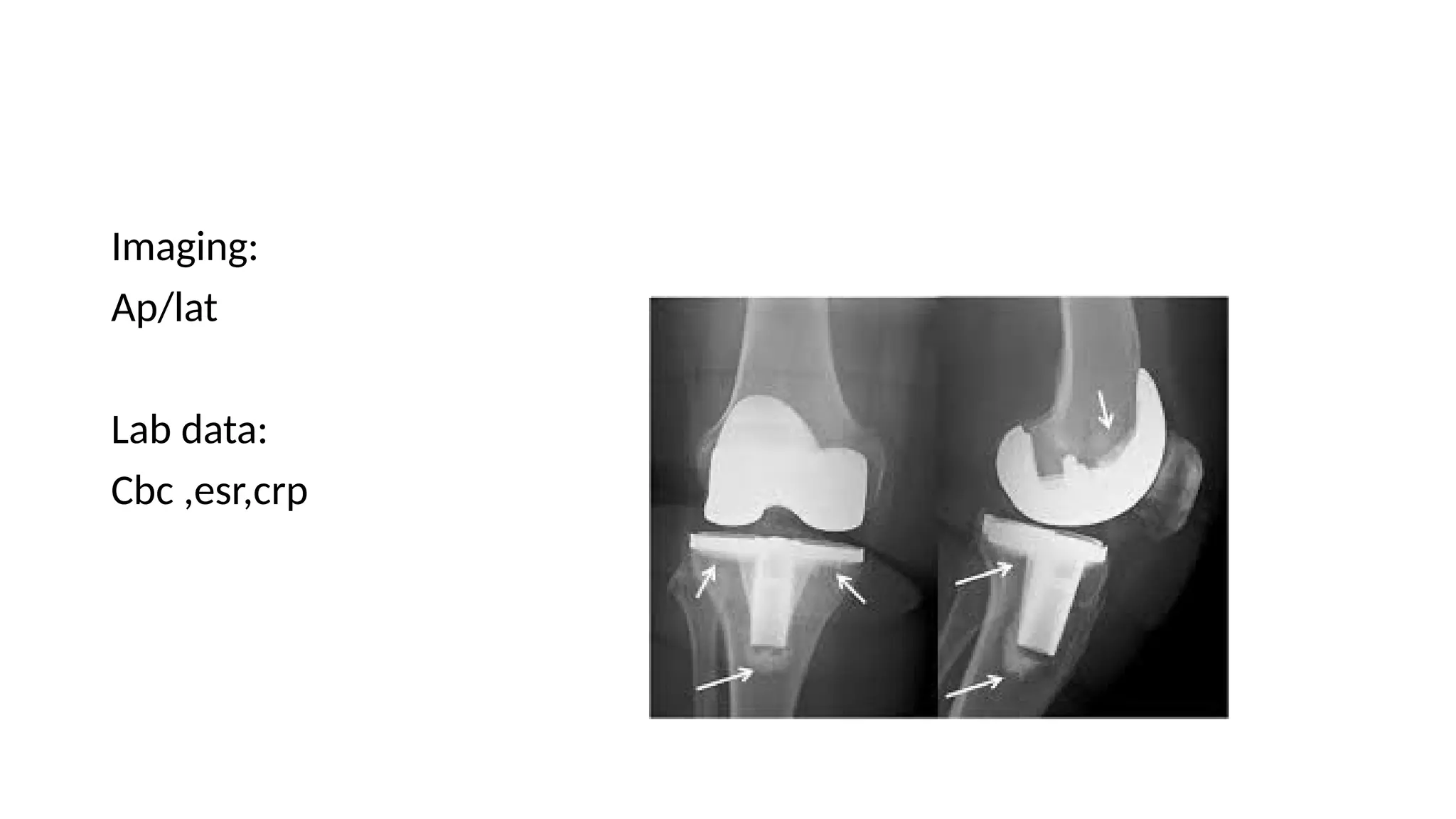 periprosthetic joint infection in the knee and hip.pptx