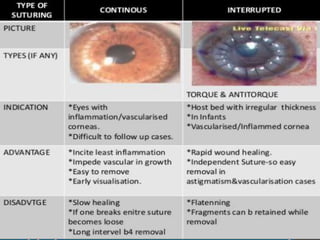 Penetrating Keratoplasty