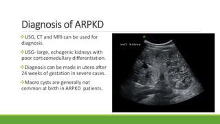 Polycystic Kidney Disease | PPTX