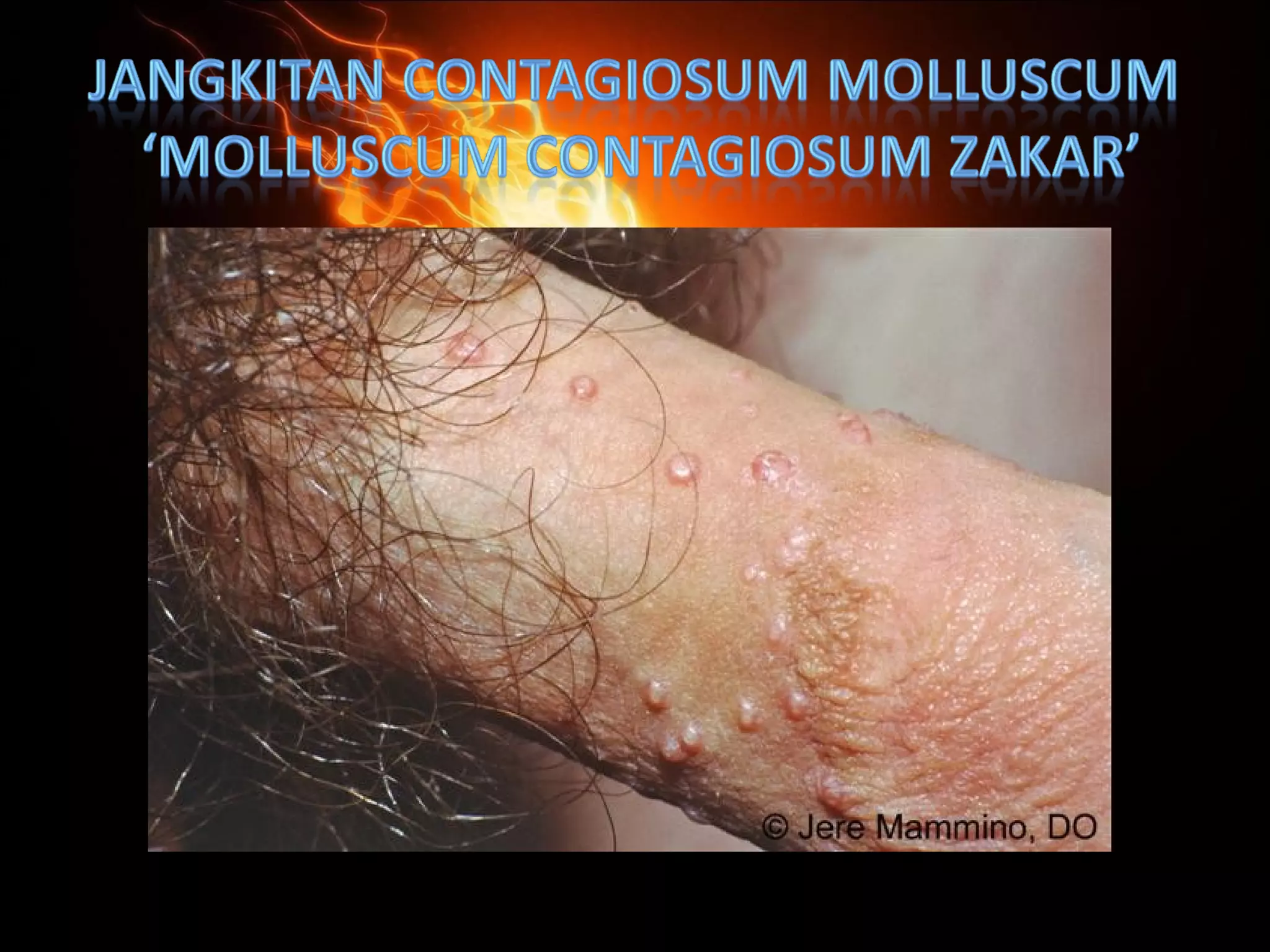 Pke3101 seksualiti pendidikan kesihatan_molluscum contagiosum | PPT