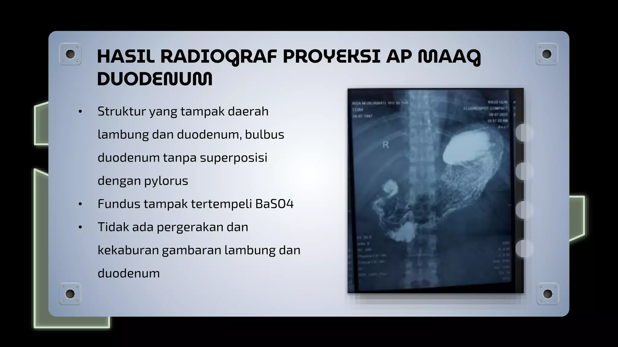 PKL II TEKNIK PEMERIKSAAN OMD KLINIS GERD.pptx