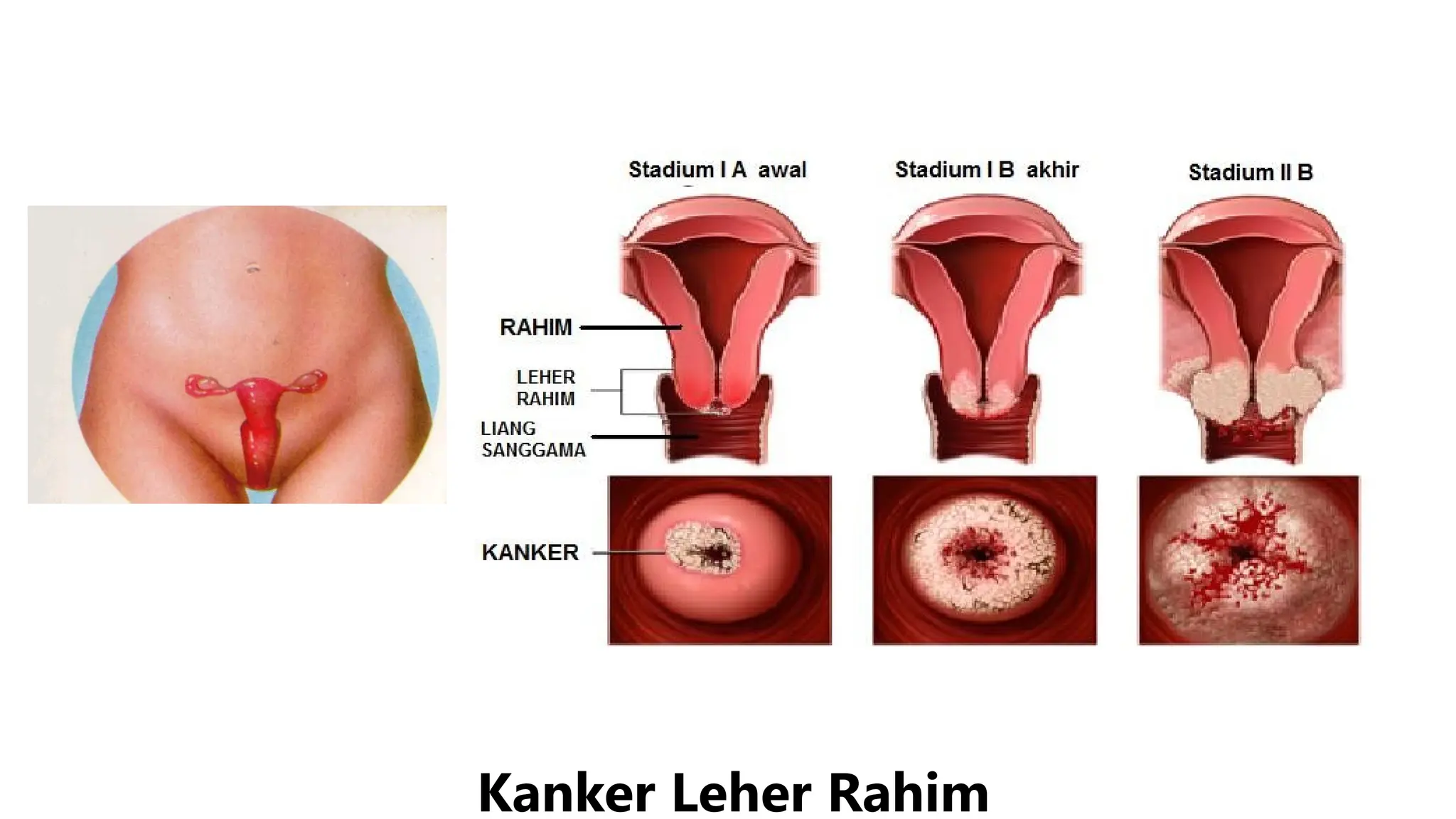 Penyuluhan Kesehatan Kanker Leher Rahim (Ca Cervix) | PPTX
