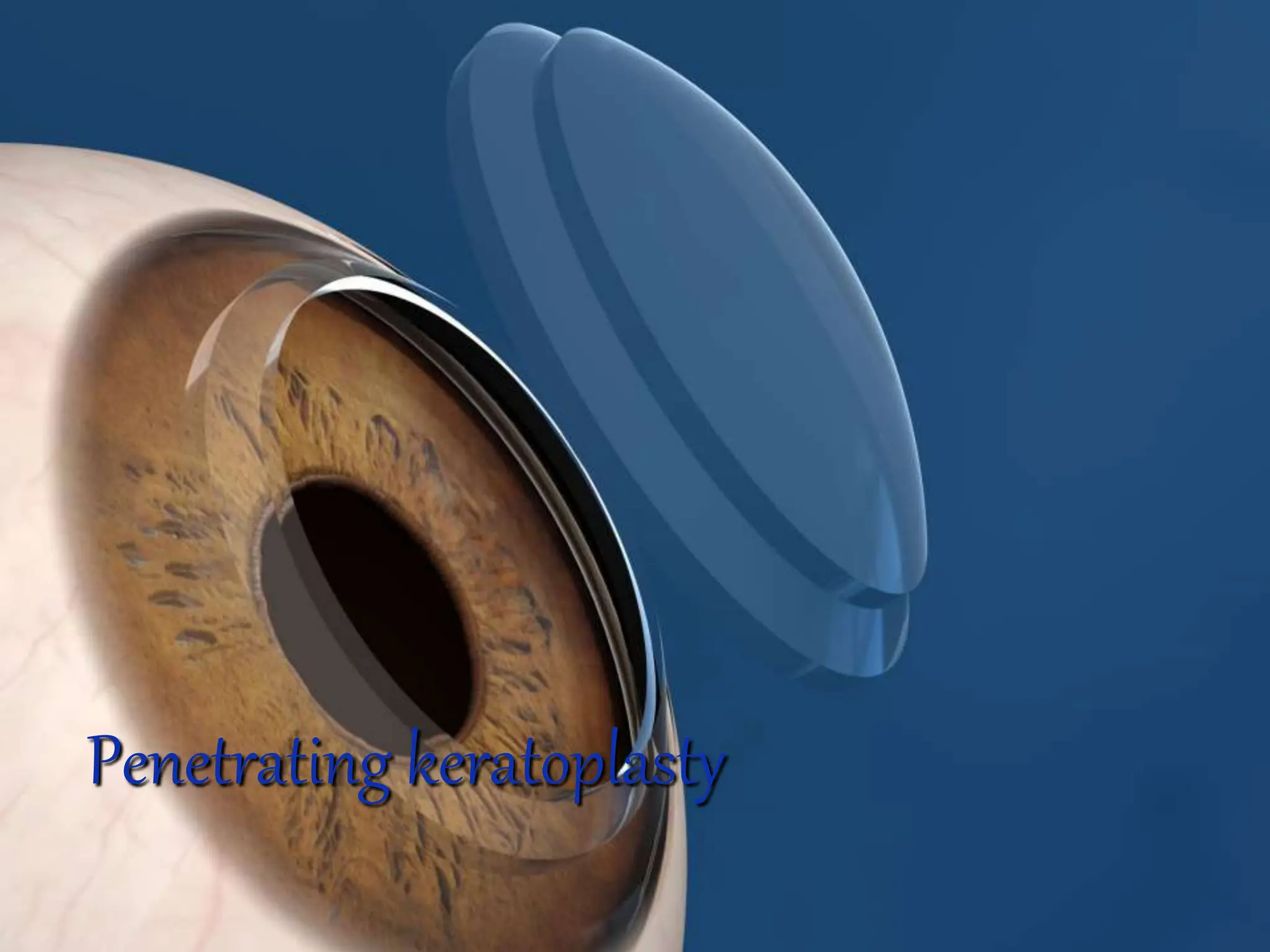 management of corneal scar, penetrating keratoplasty | PPT