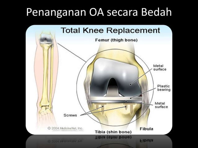 PENYULUHAN OA GENU untuk awam | PPTX