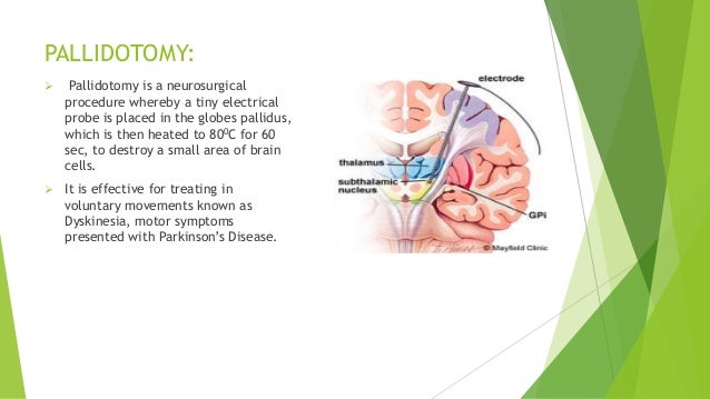 PARKINSON'S DISEASE