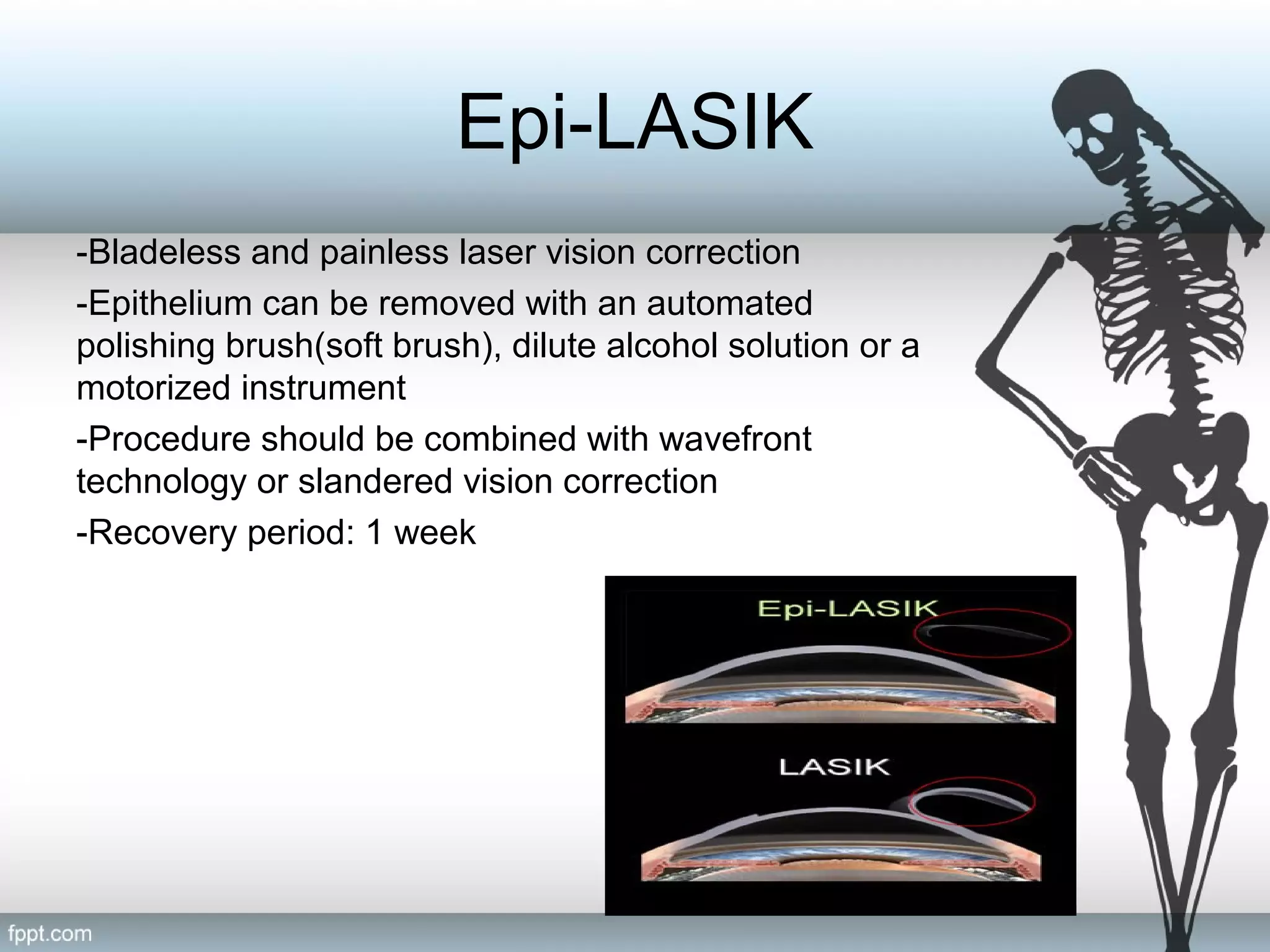 REFRACTIVE SURGERY | PPT