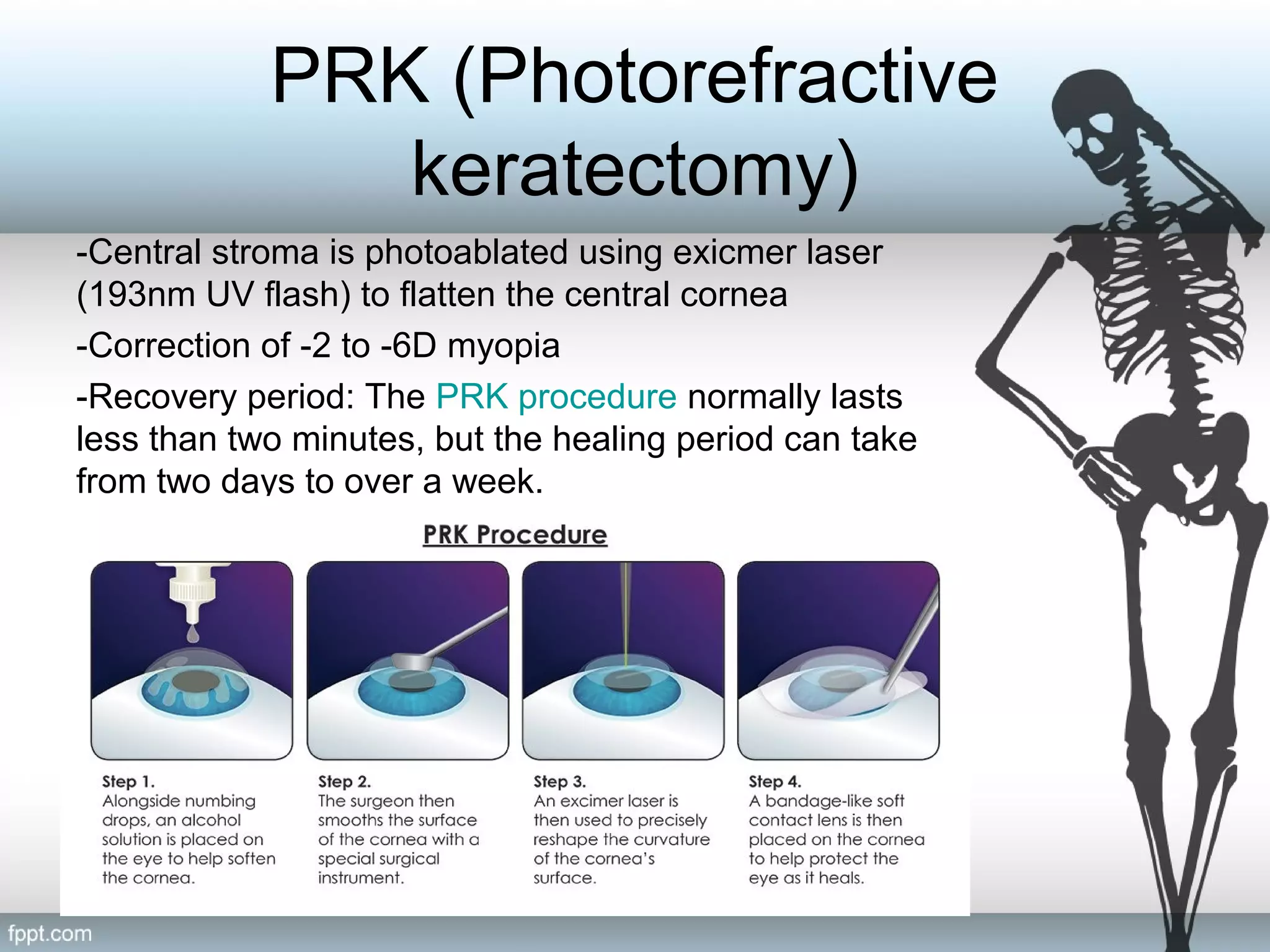 REFRACTIVE SURGERY | PPT