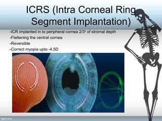 REFRACTIVE SURGERY | PPT