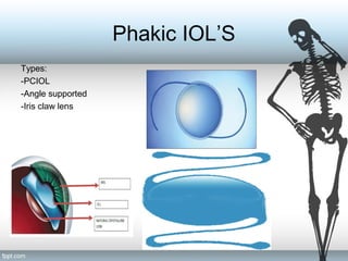 REFRACTIVE SURGERY | PPT