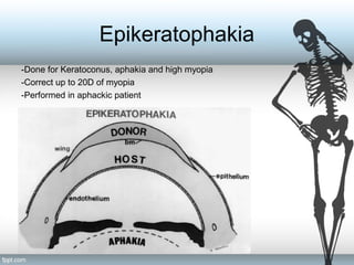 REFRACTIVE SURGERY | PPT