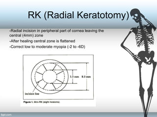 REFRACTIVE SURGERY | PPT