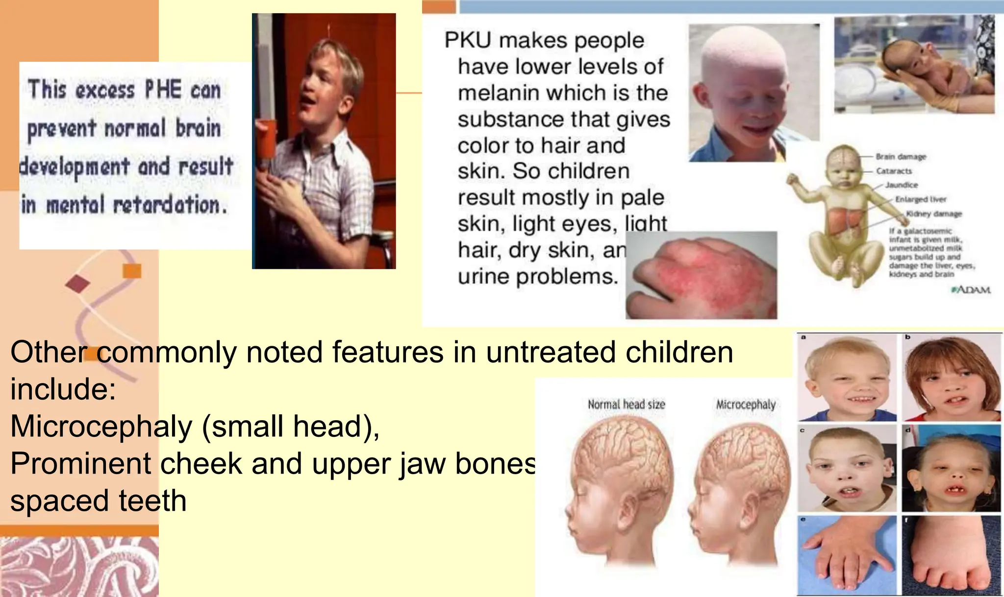 PKU-biochemical genetic disorder- 19.1.2023.ppt