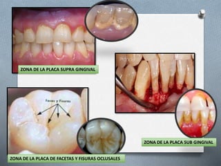 PLACA DENTAL | PPTX