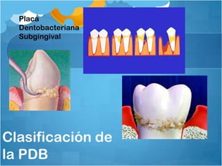 Placa dentobacteriana | PPTX