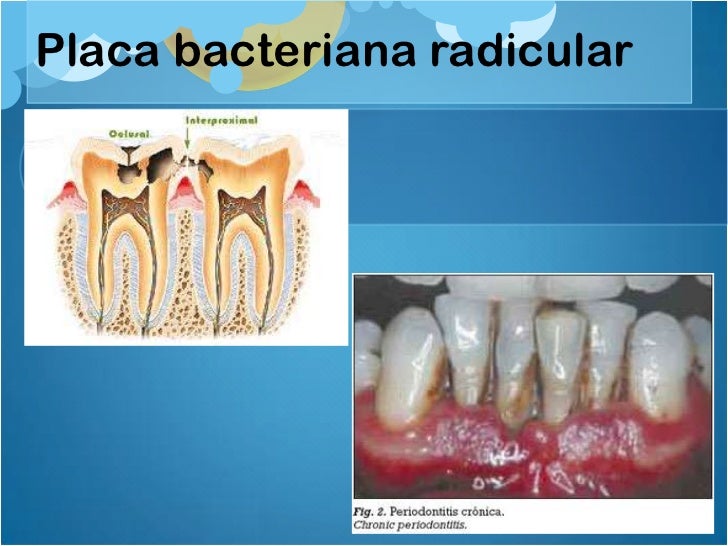 Radicular Significado