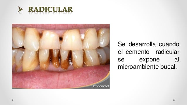 Placa dentobacteriana