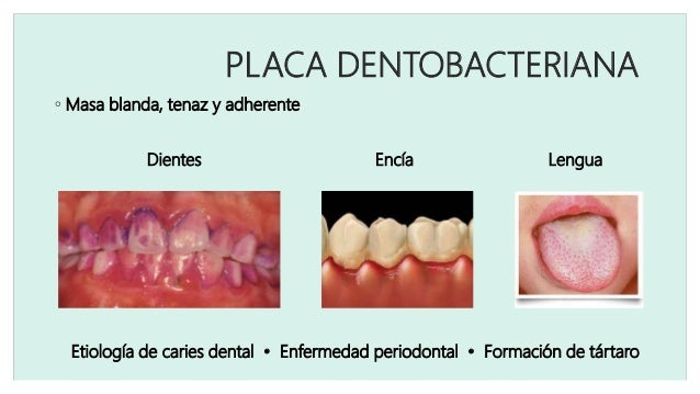 Placa dentobacteriana y_calculo_dental