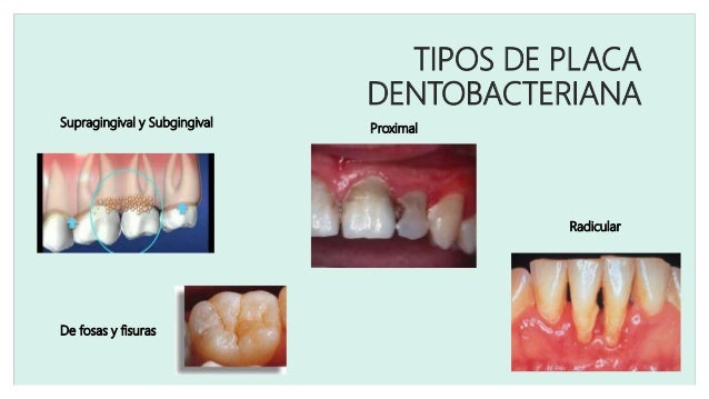 Placa dentobacteriana y_calculo_dental