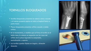 PLACAS BLOQUEADAS Y ESPECIALES DE LA OSTEOSÍNTESIS.pptx