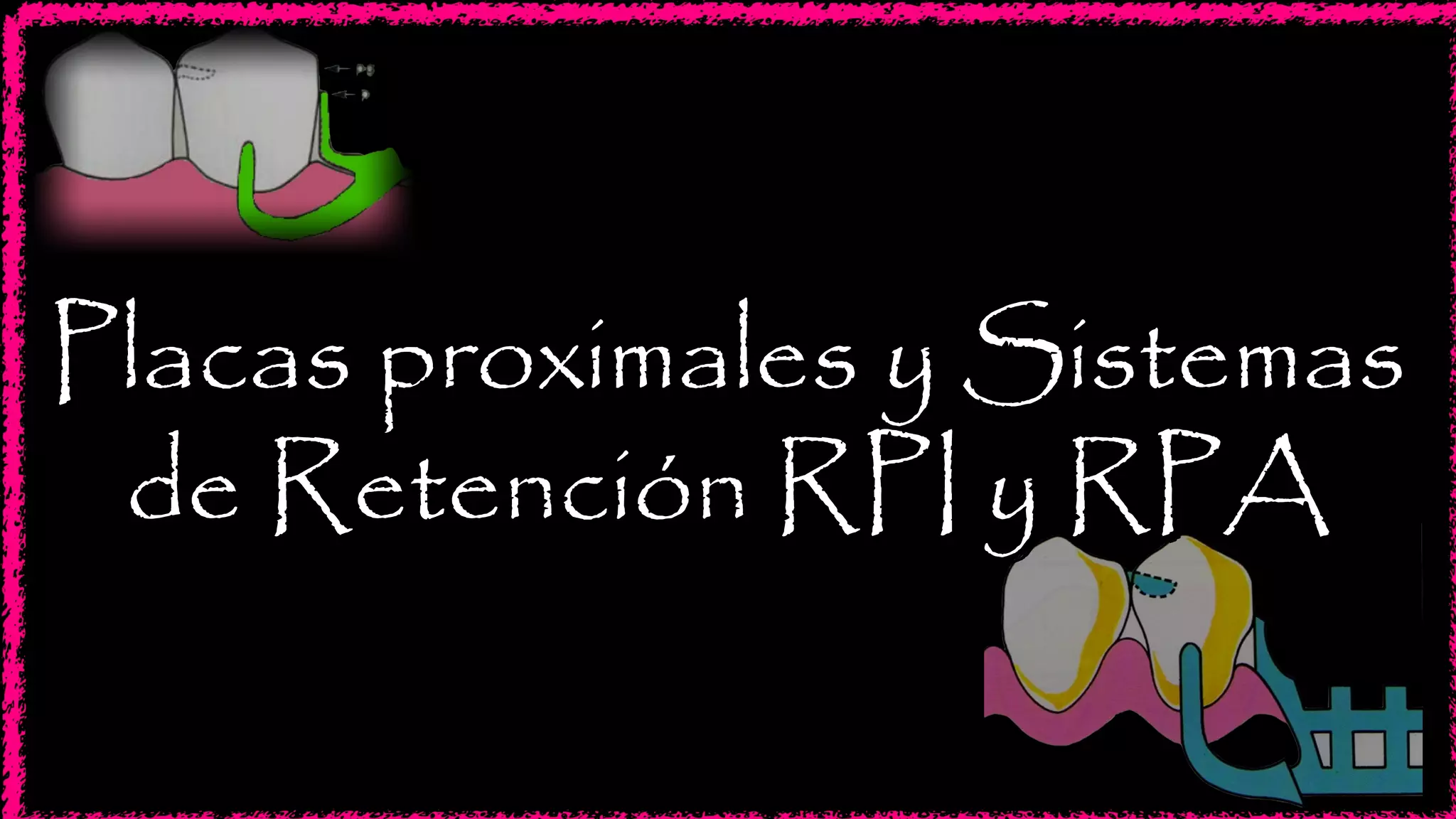 Placas proximales y Retenedores DPI DPA / RPI RPA | PPT