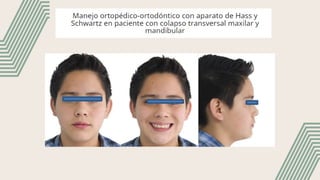 Placas Swartz. historia,ventajas, desventajas, indicaciones | PDF