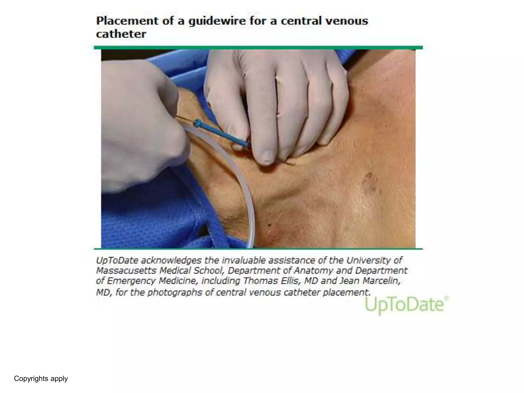 Placement of a guidewire for a central venous catheter | PPTX