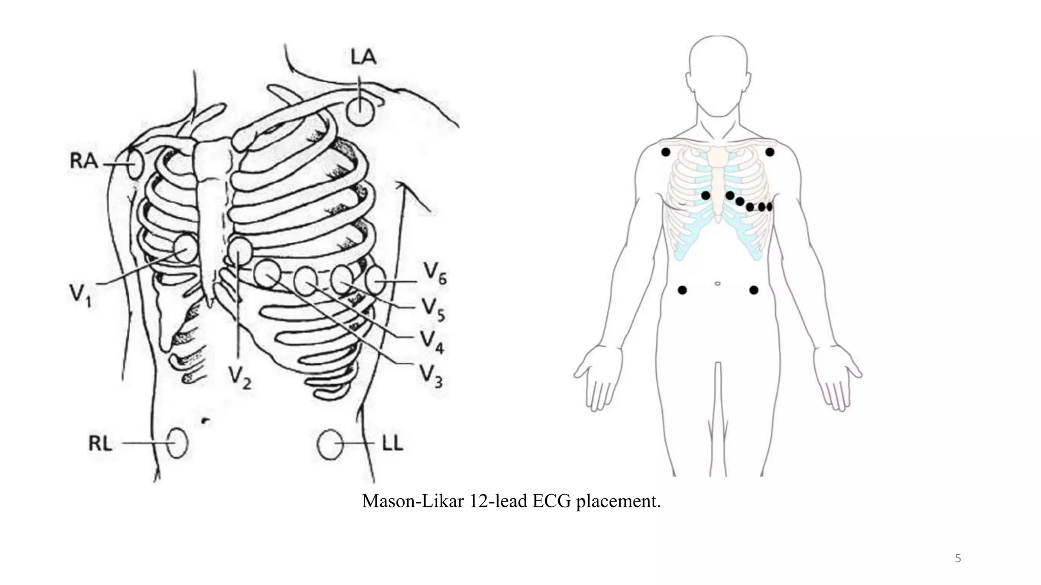 Placement of ecg leads during exercise (cardio ppt) | PPTX