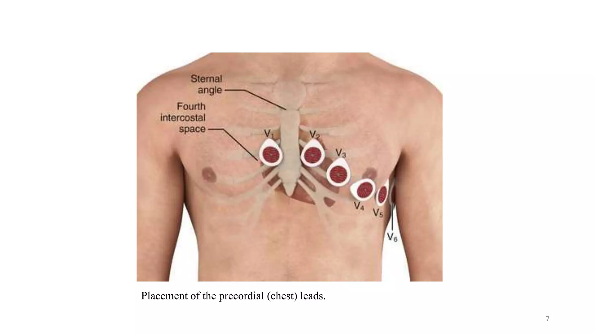 Placement of ecg leads during exercise (cardio ppt) | PPTX