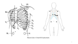 Placement of ecg leads during exercise (cardio ppt) | PPTX
