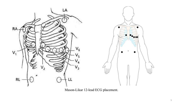 Placement of ecg leads during exercise (cardio ppt) | PPTX | Heart and ...