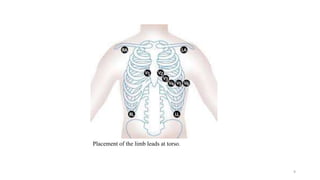 Placement of ecg leads during exercise (cardio ppt) | PPTX