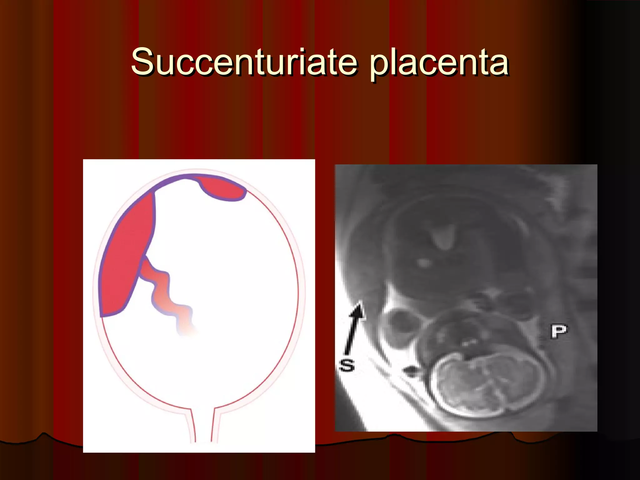 Placenta ultrasound | PPT