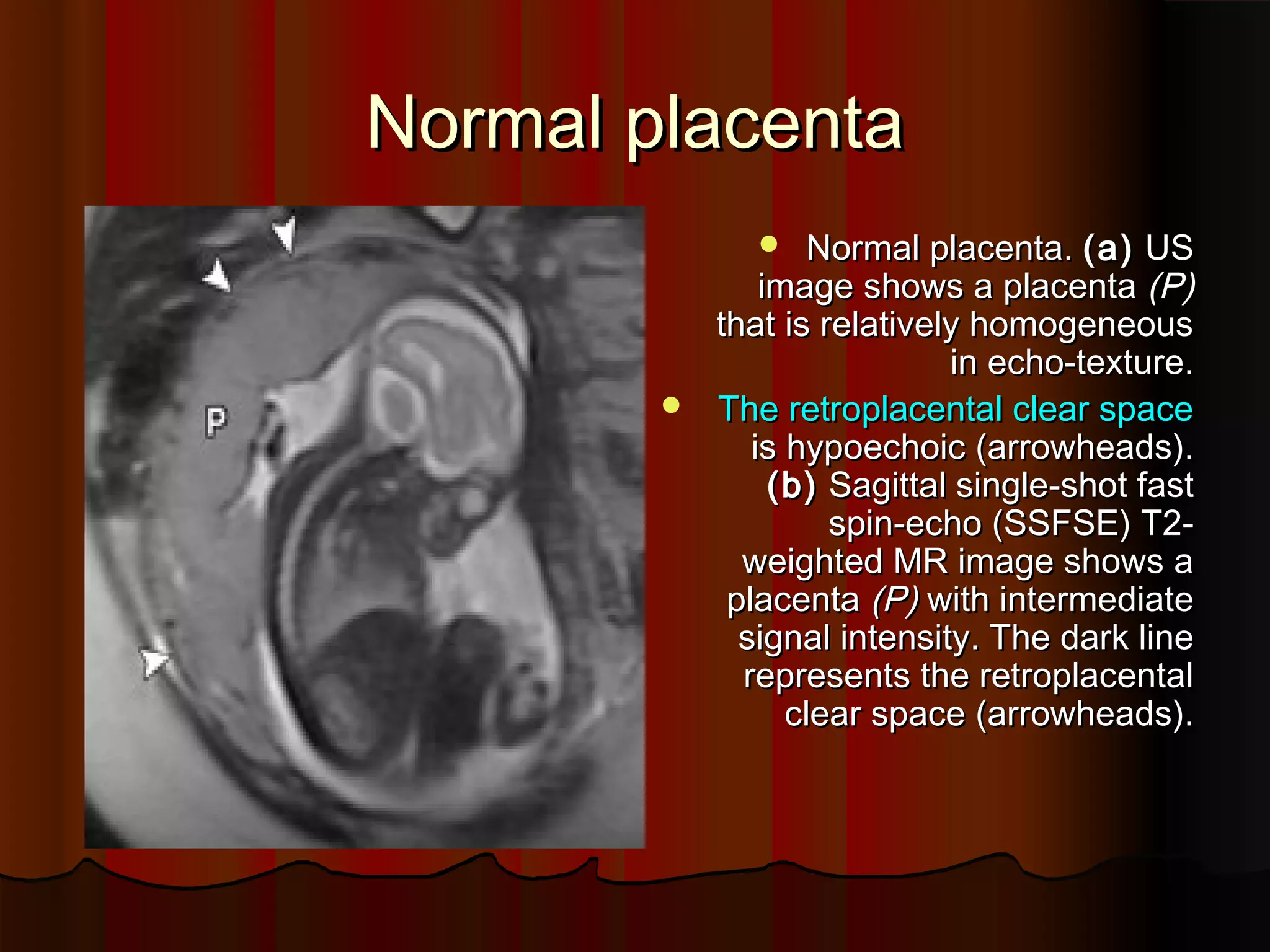 Placenta ultrasound | PPT