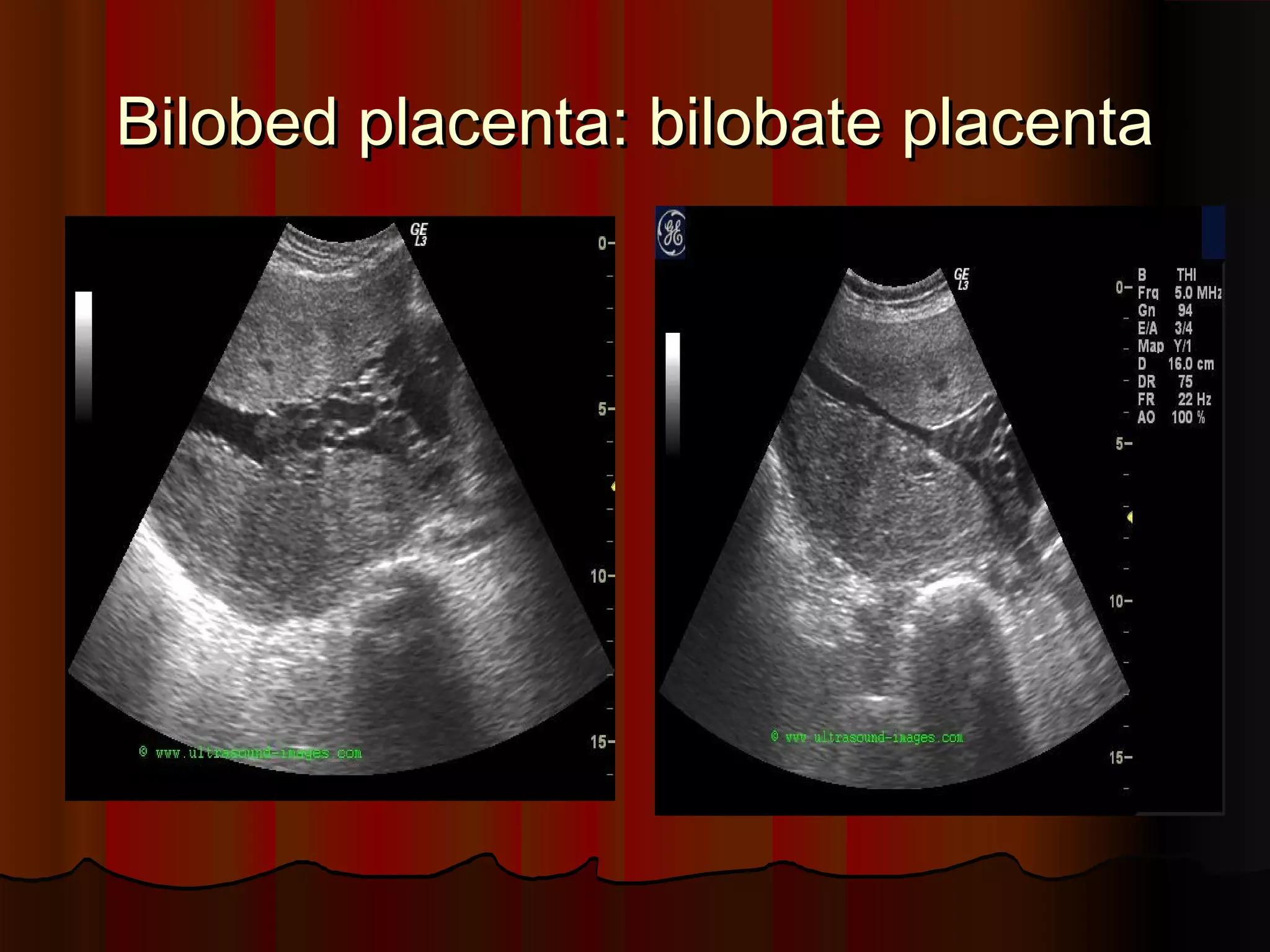 Placenta ultrasound | PPT