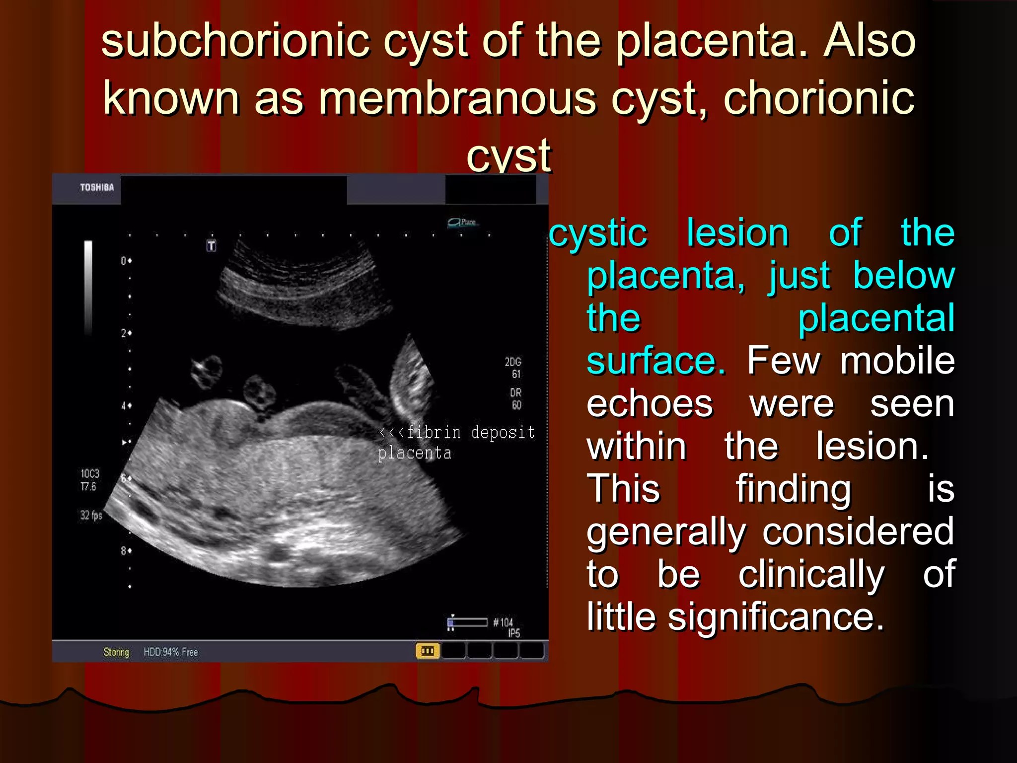 Placenta ultrasound | PPT