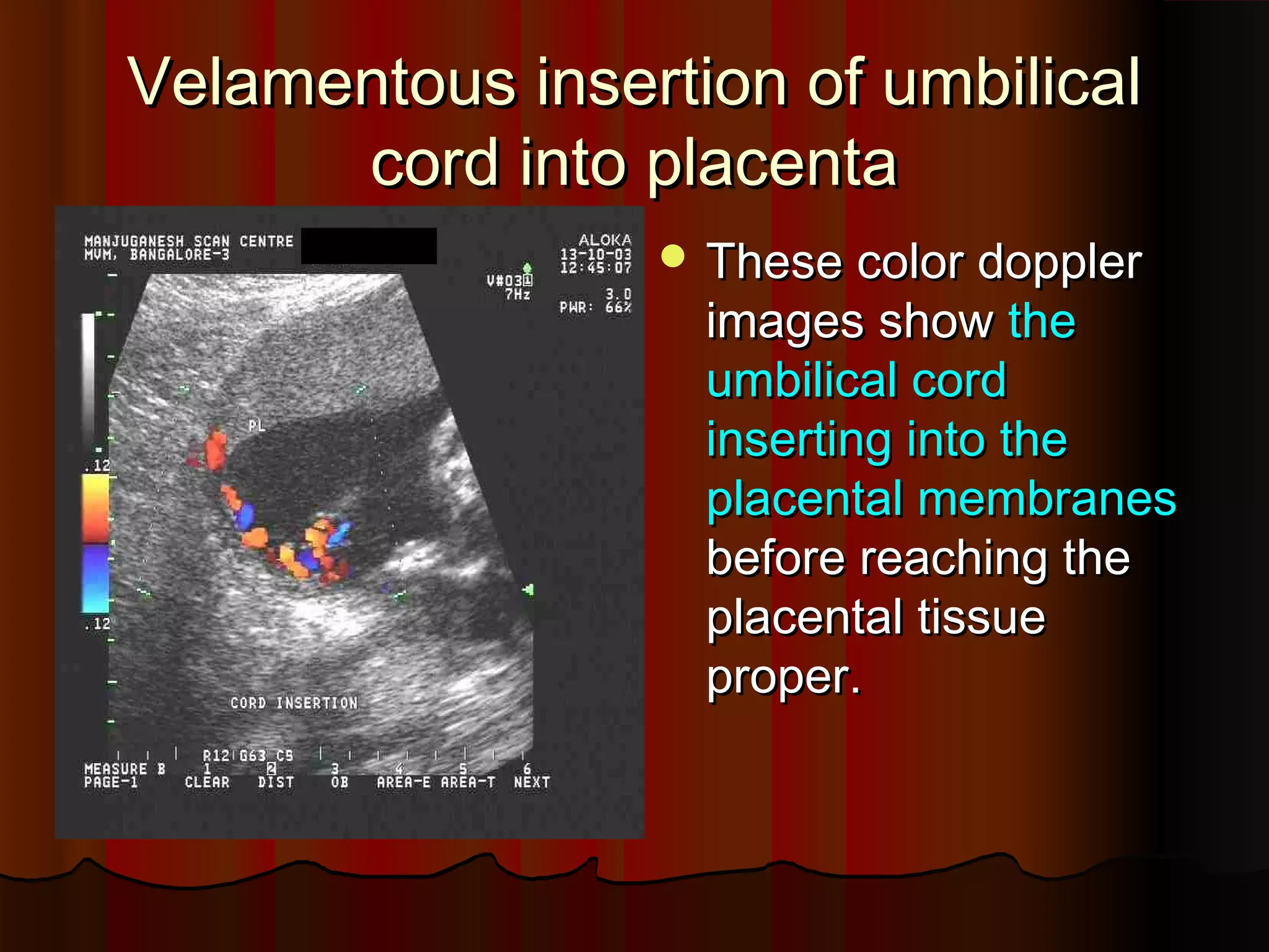 Placenta ultrasound | PPT