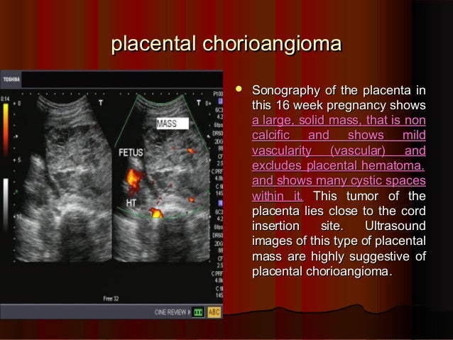 Placenta ultrasound
