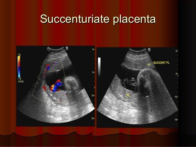 Placenta ultrasound