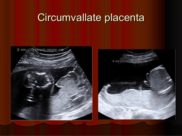 Placenta ultrasound