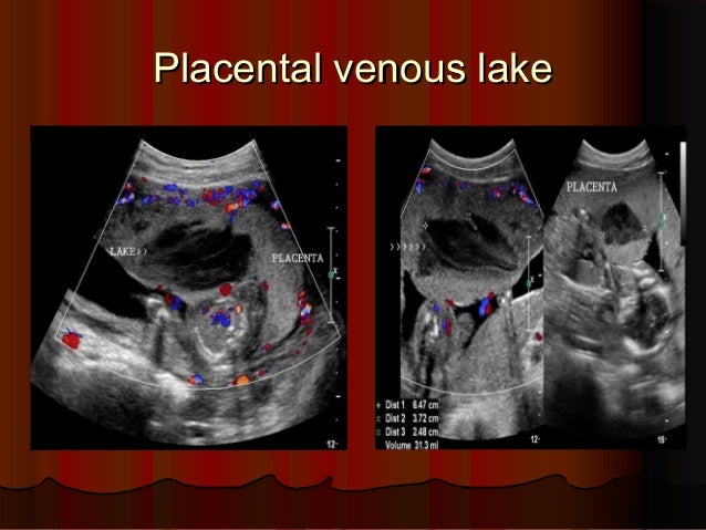 Placenta ultrasound