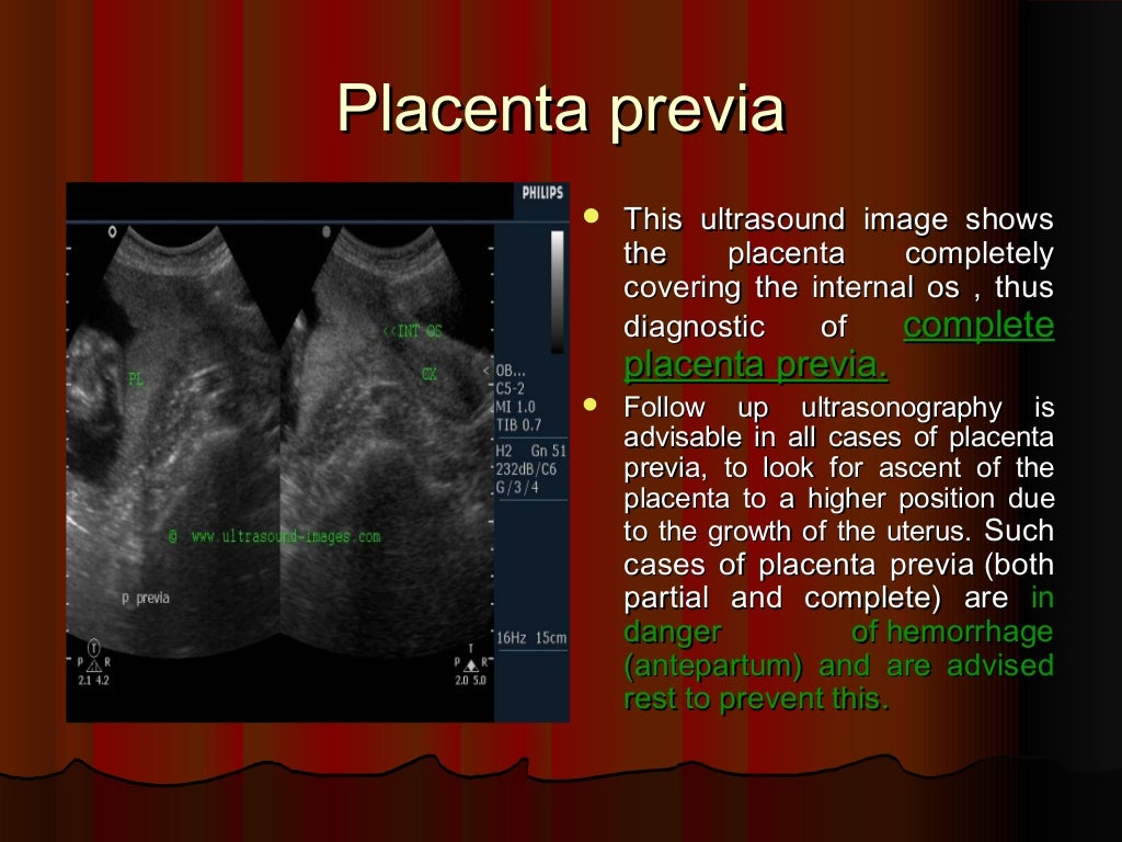 Placenta ultrasound