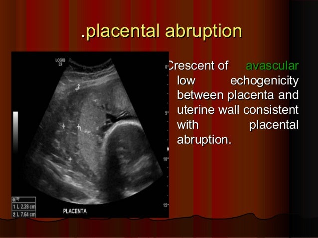 Placental abruption | Medical ultrasound, Diagnostic medical sonography ...