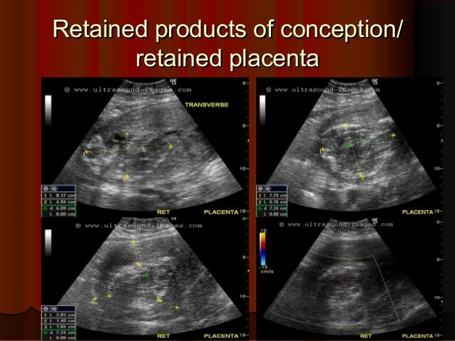 Placenta ultrasound