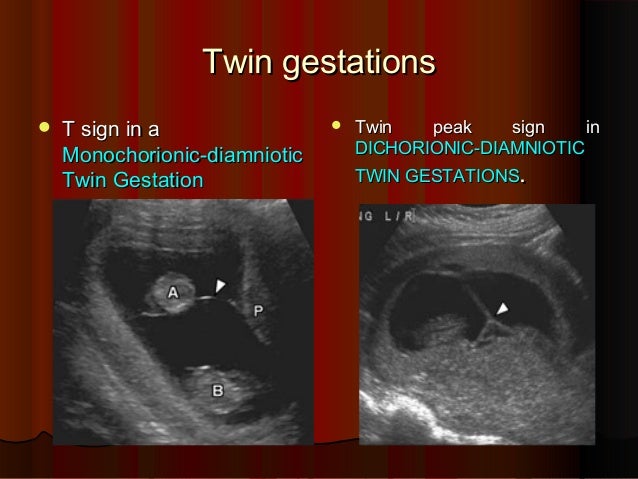 Placenta Ultrasound