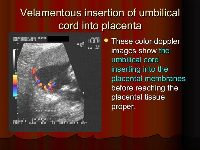 Placenta ultrasound