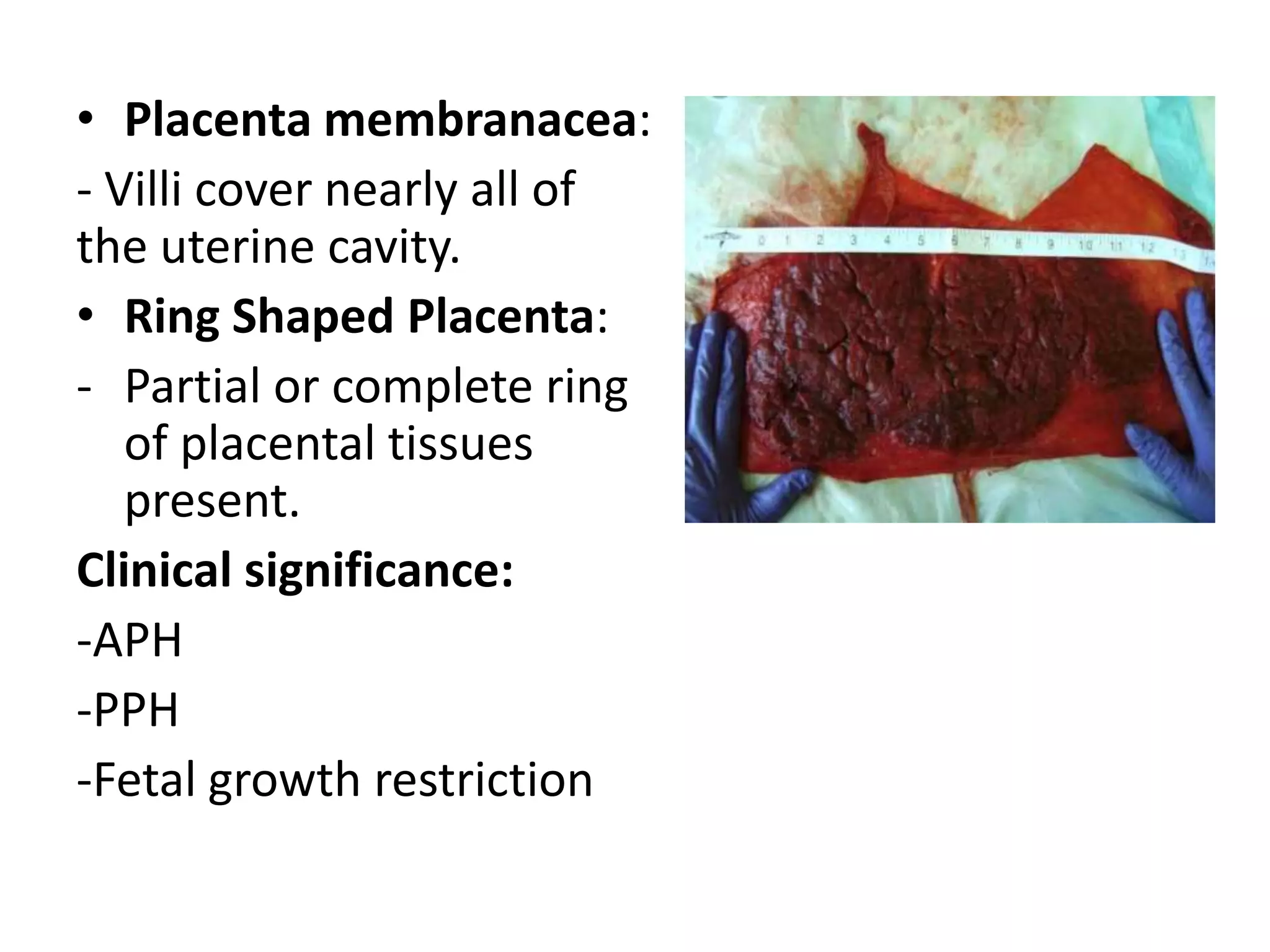 Placenta development and its abnormalities | PPTX